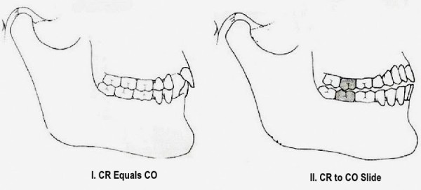 Anterior Guidance - Digital Occlusion
