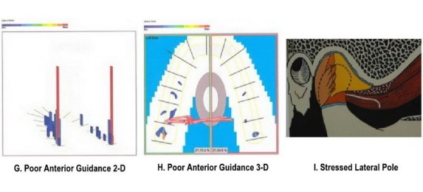 Anterior Guidance - Digital Occlusion